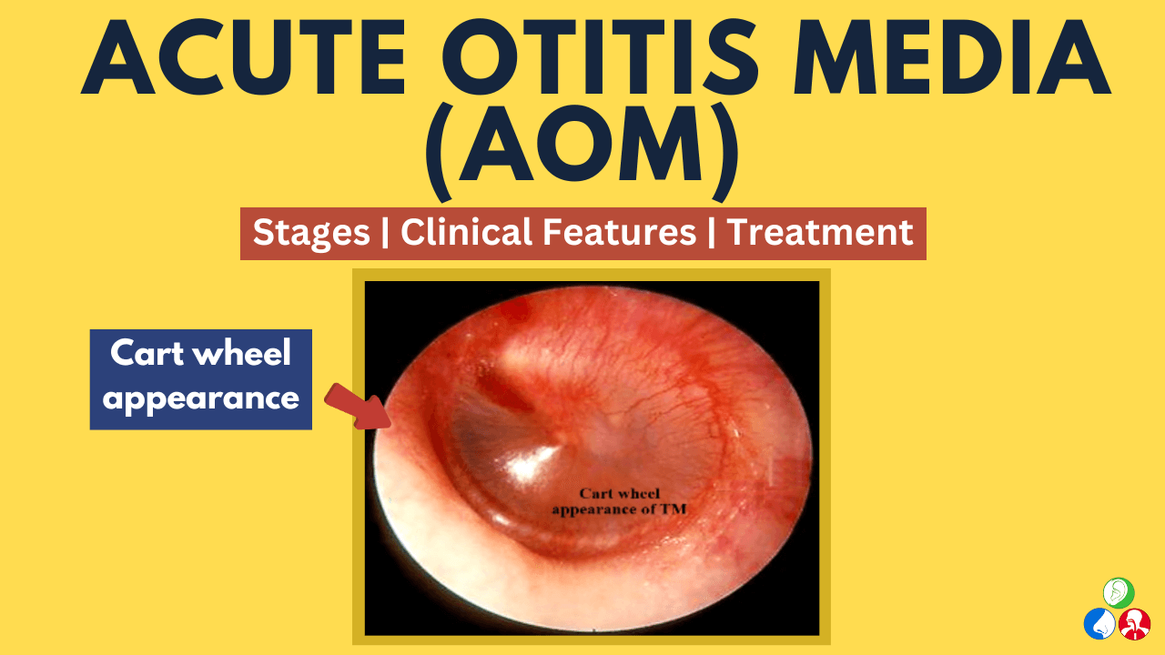 Acute Otitis Media - Causes, Symptoms and Treatment | ENT Notes & Lectures
