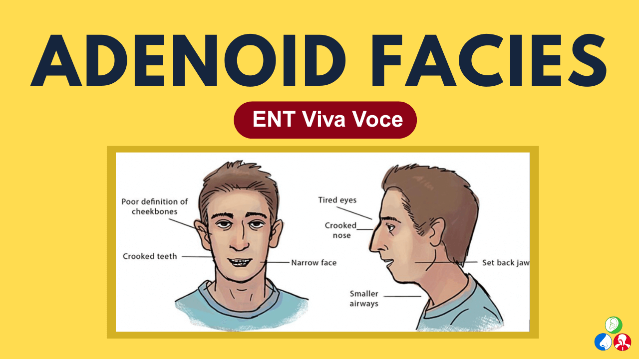 Adenoid Facies | ENT Notes & Lectures