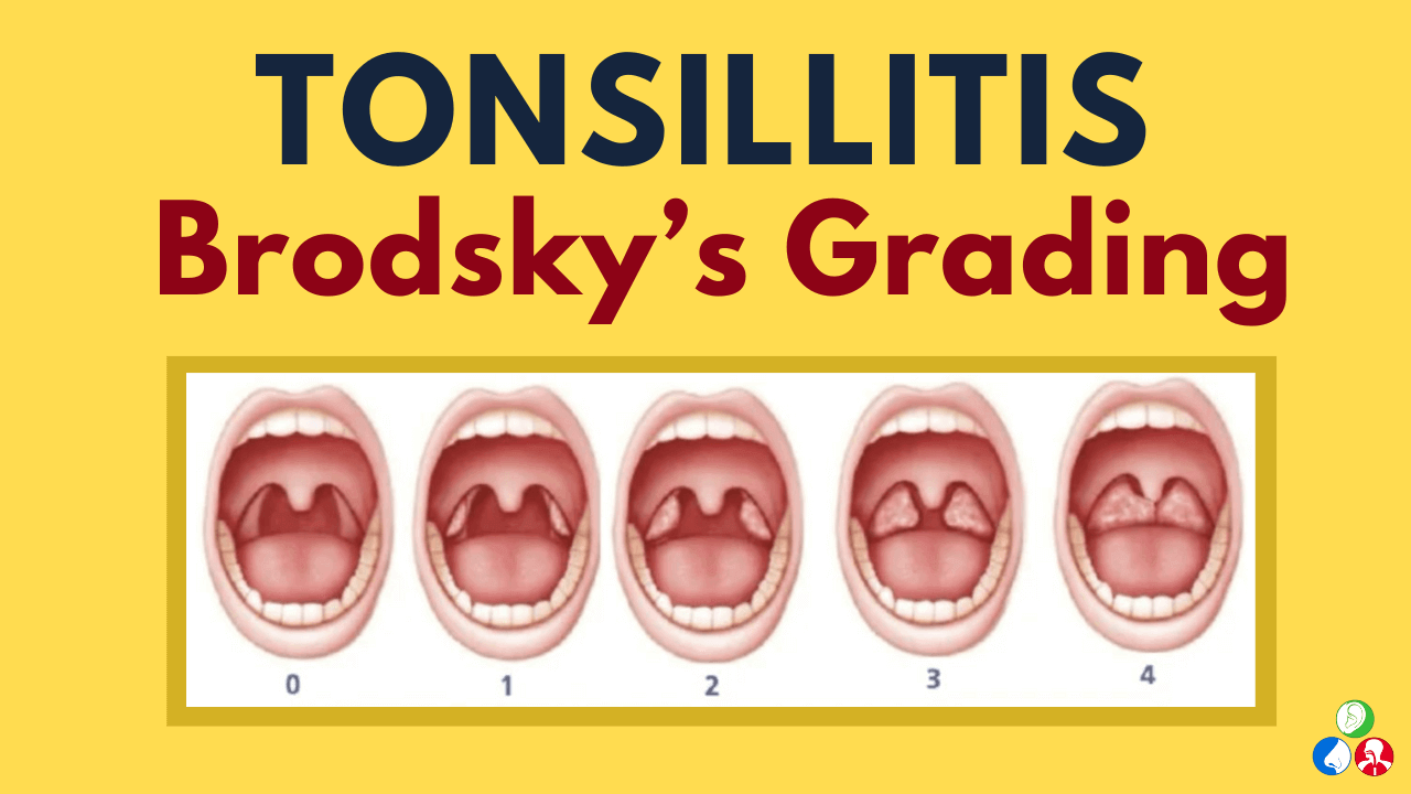Brodsky Grading of Tonsillar Enlargement | ENT Notes & Lectures