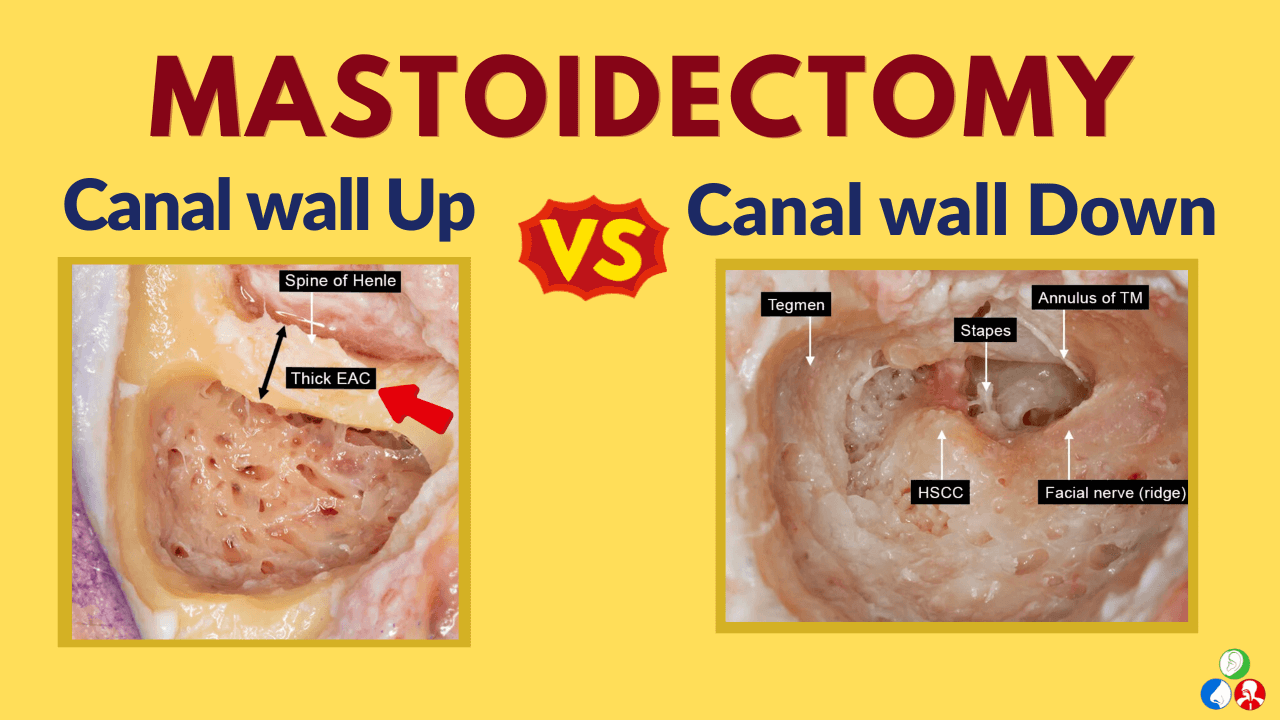 Canal wall Down VS Canal wall Up Mastoidectomy | ENT Notes & Lectures