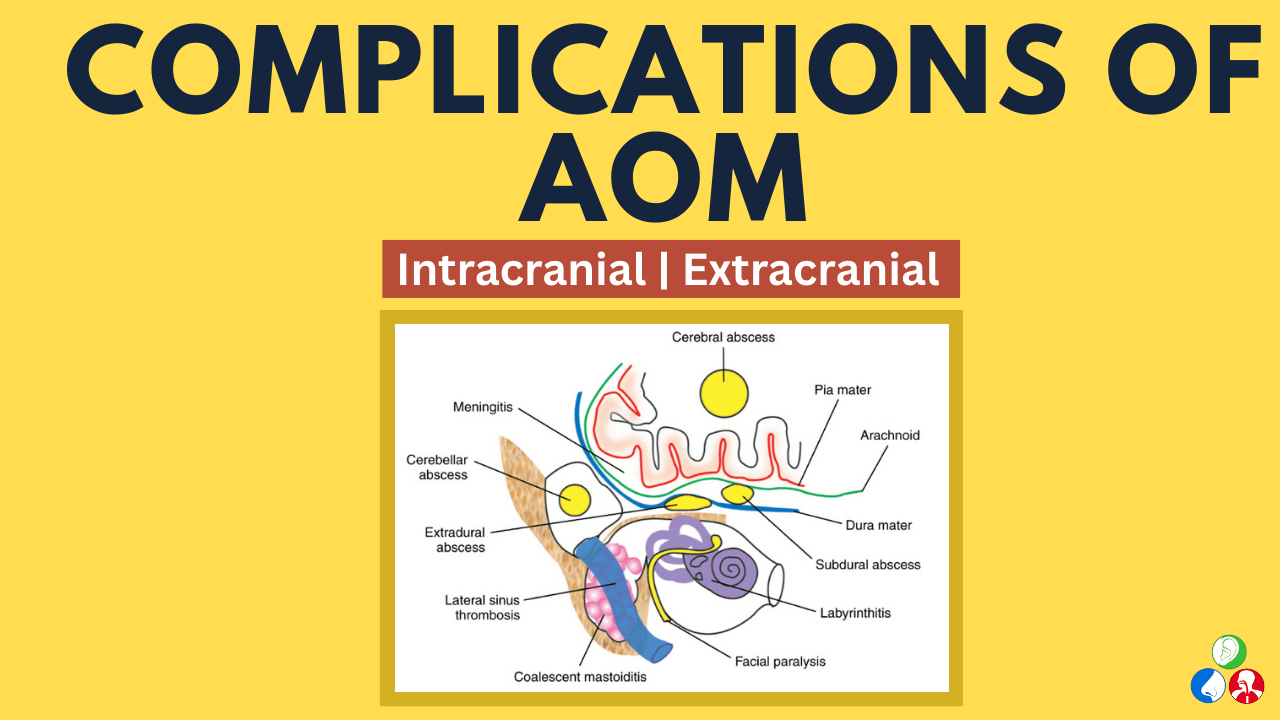 Complications of Acute Otitis Media | ENT Notes & Lectures