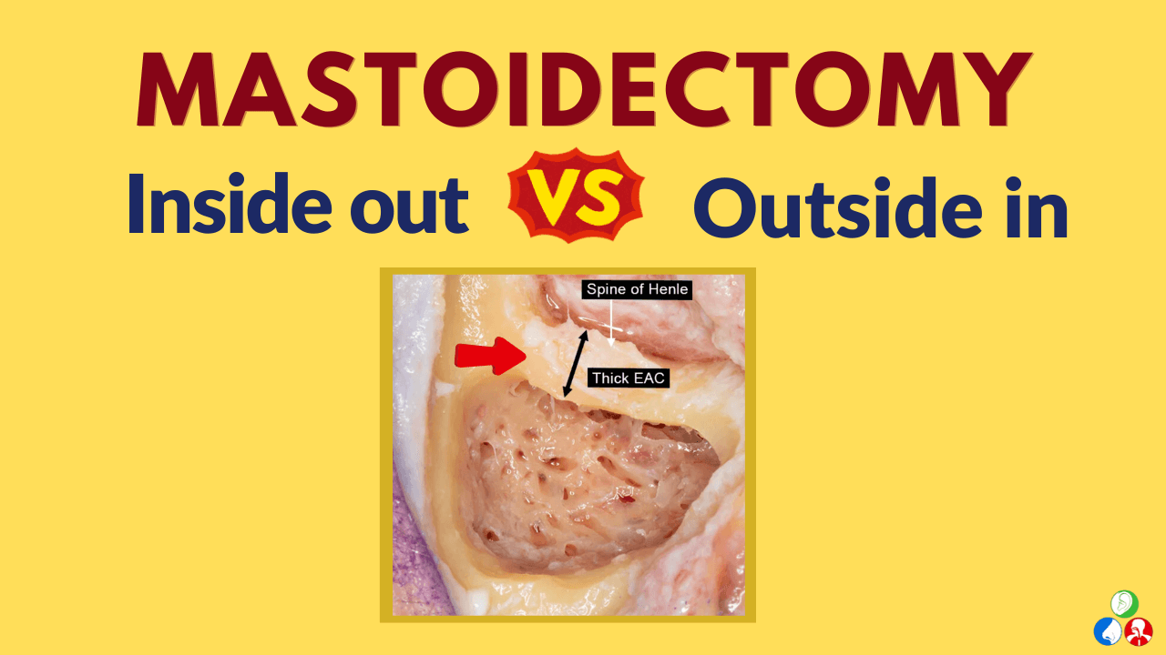 Inside out VS Outside in Mastoidectomy | ENT Notes & Lectures