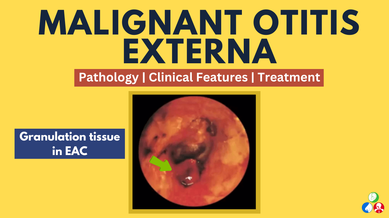 Malignant Otitis Externa (Skull Base Osteomyelitis) | ENT Notes & Lectures