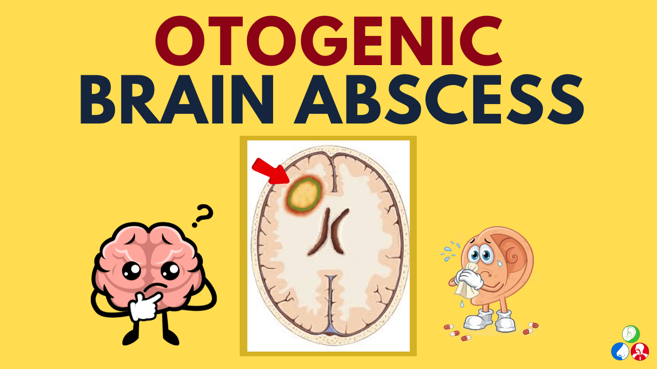Otogenic Brain Abscess | ENT Notes & Lectures