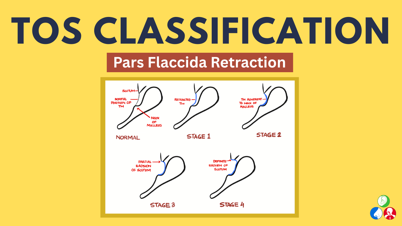Tos Classification - Pars Flaccida Retraction | ENT Notes & Lectures
