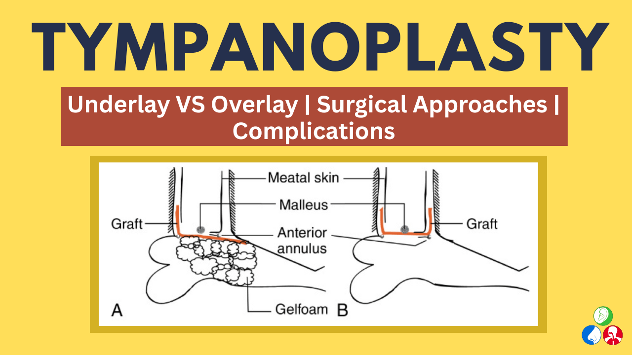 Tympanoplasty Part 2 - Approaches, Techniques, Steps & Complications ...