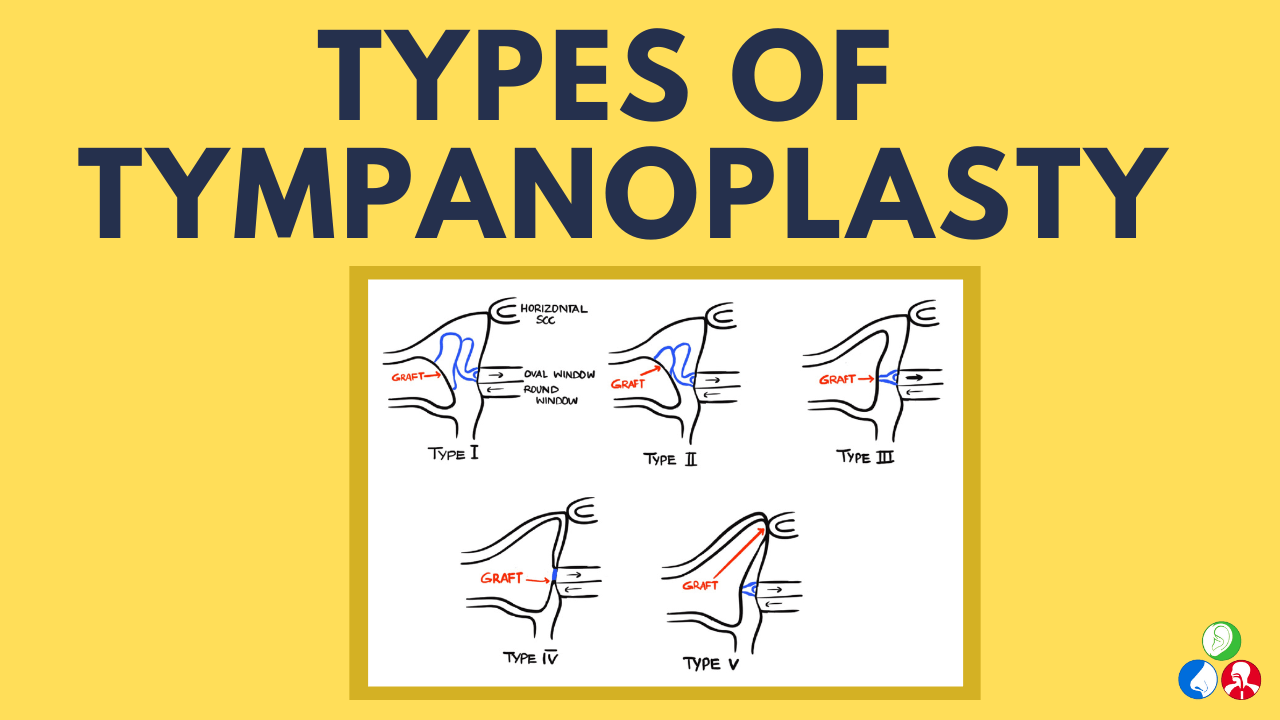 Types of Tympanoplasty - Wullstein Classification | ENT Notes & Lectures